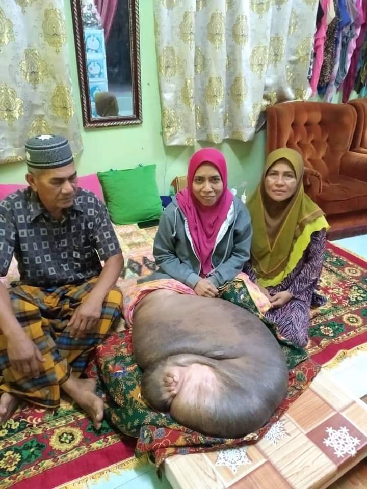 Rosmiza mohon bantuan kos pembedahan penyakit kaki gajah - SAHIH